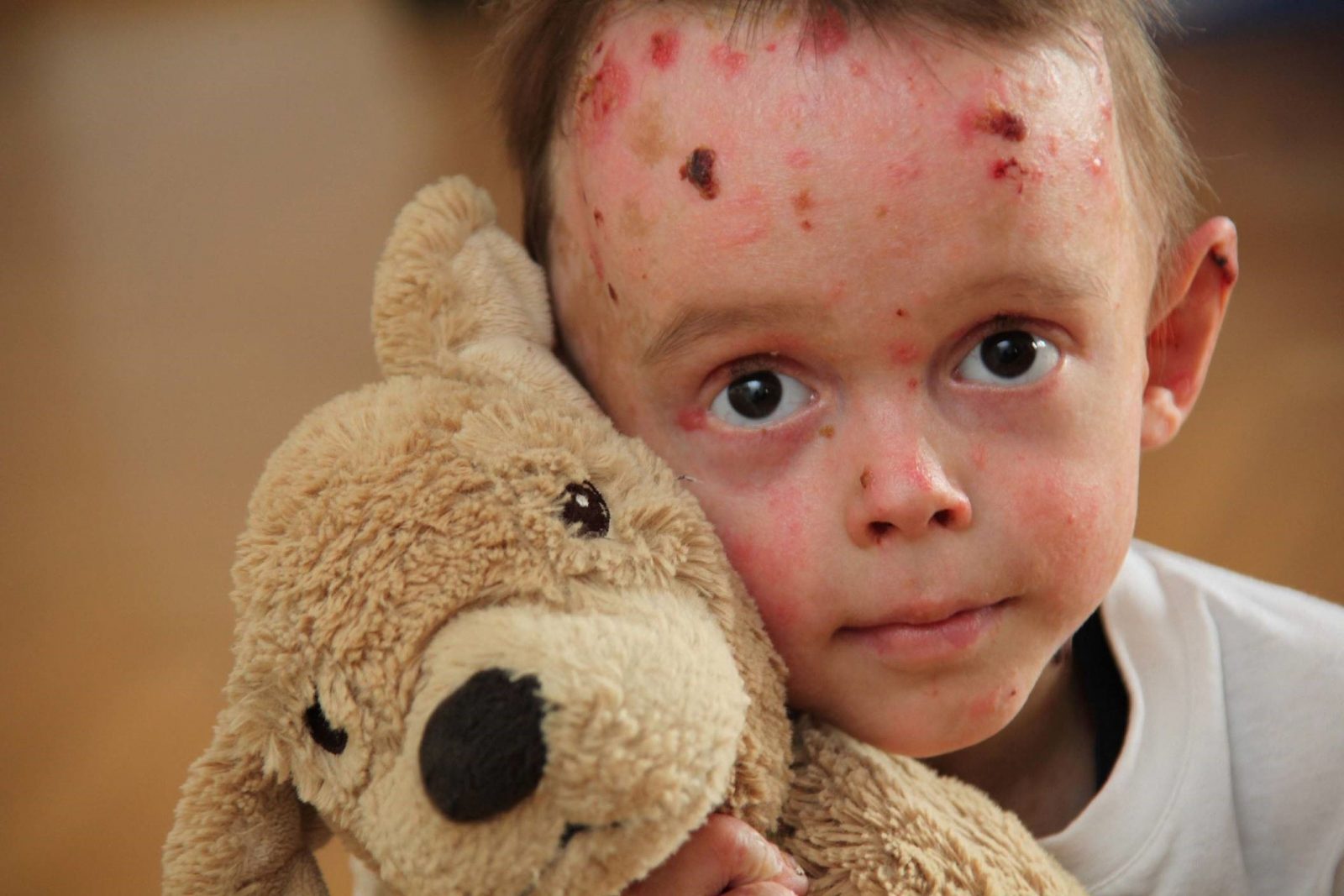 Alliance enables trial for epidermolysis bullosa treatment - LifeArc